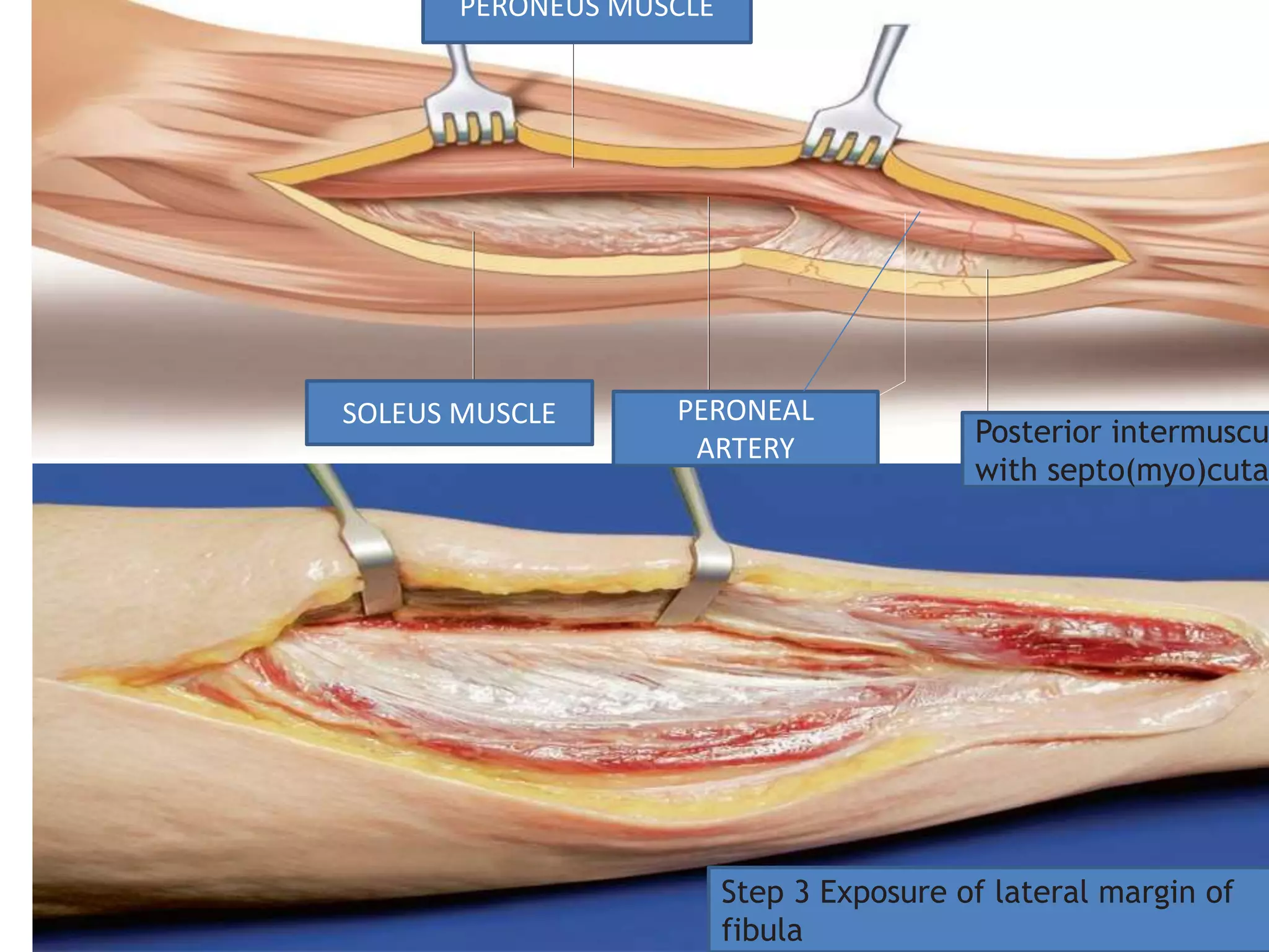 Flap techniques | PPTX