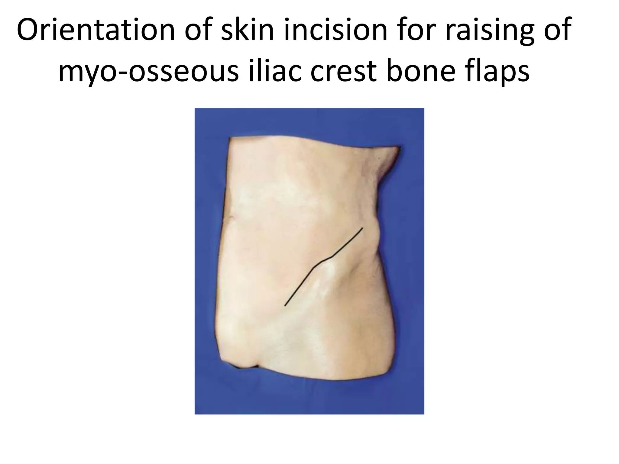 Flap techniques | PPTX