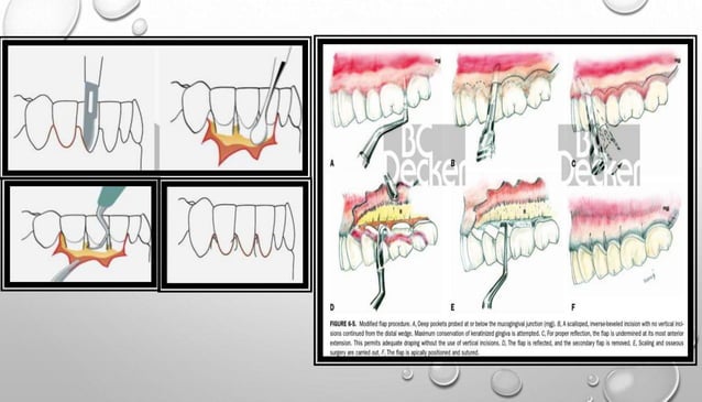 FLAP TECHNIQUES.pptx