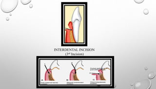 FLAP TECHNIQUES.pptx