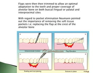 Flap techniques for pocket therapy | PPTX
