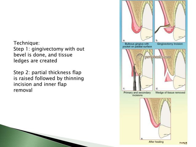 Flap techniques for pocket therapy | PPTX | Dental Health | Diseases ...