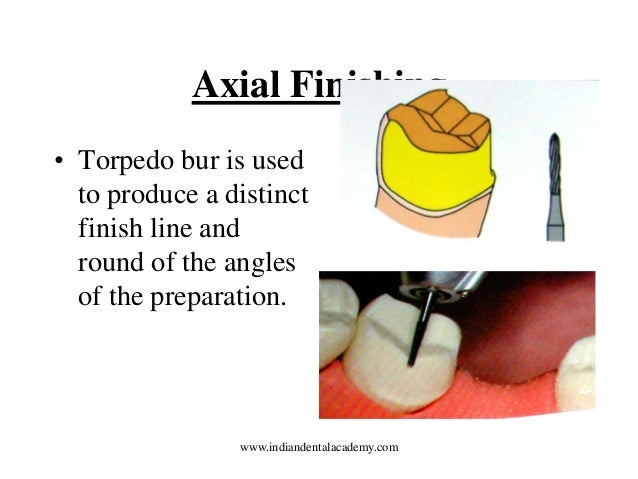 Flares /certified fixed orthodontic courses by Indian dental academy