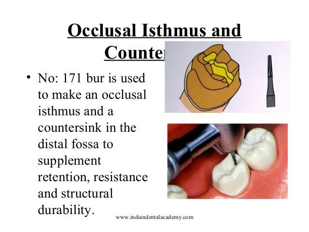 Flares in dental crown preparation /certified fixed orthodontic cours…