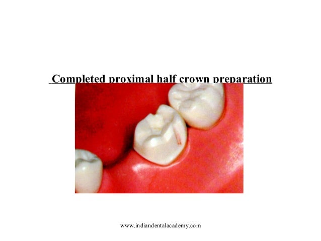 Flares in dental crown preparation /certified fixed orthodontic cours…