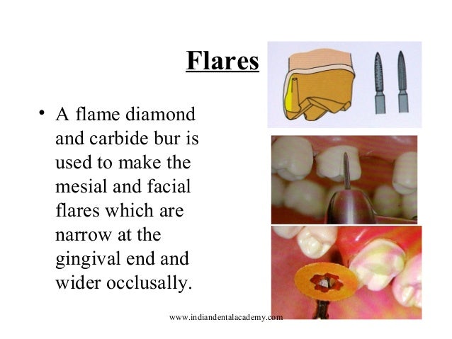 Flares in dental crown preparation /certified fixed orthodontic cours…
