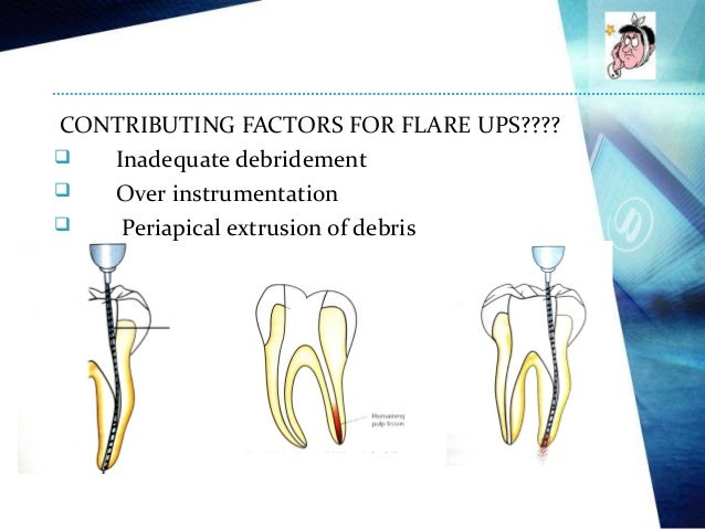 Flare up in endodontics