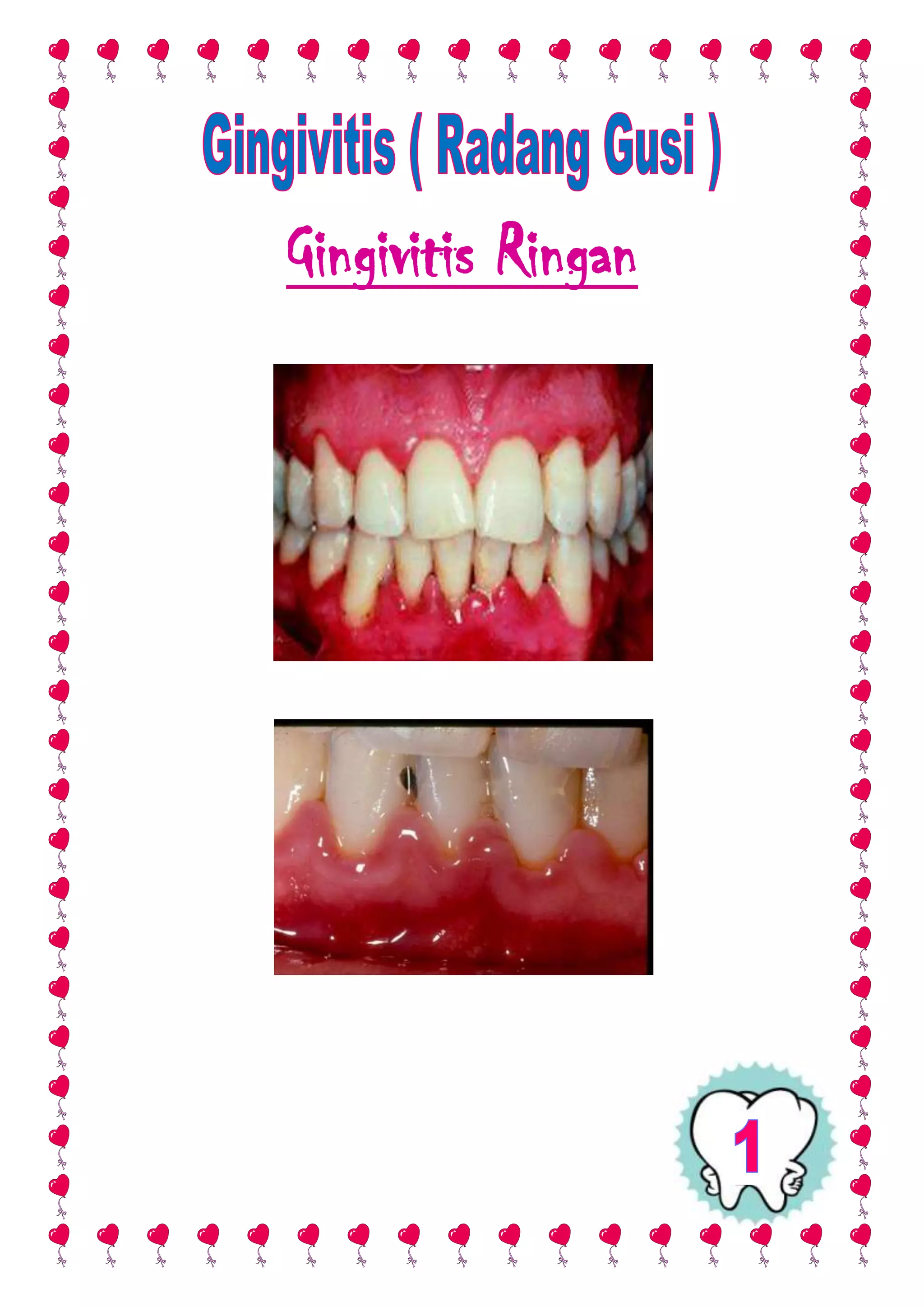 Flash card gingivitis | DOCX