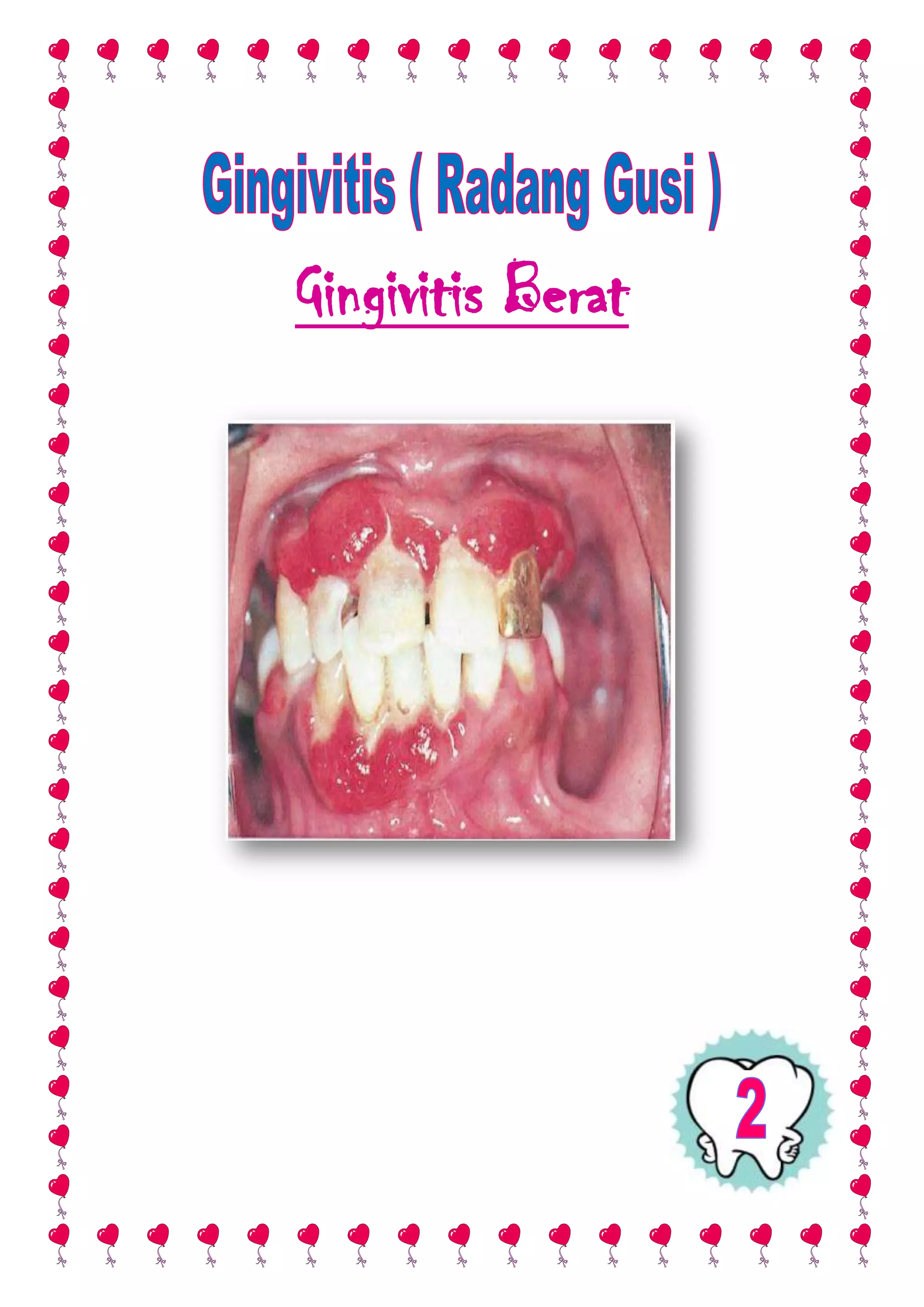 Flash card gingivitis | DOCX