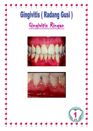 Flash card gingivitis | DOCX