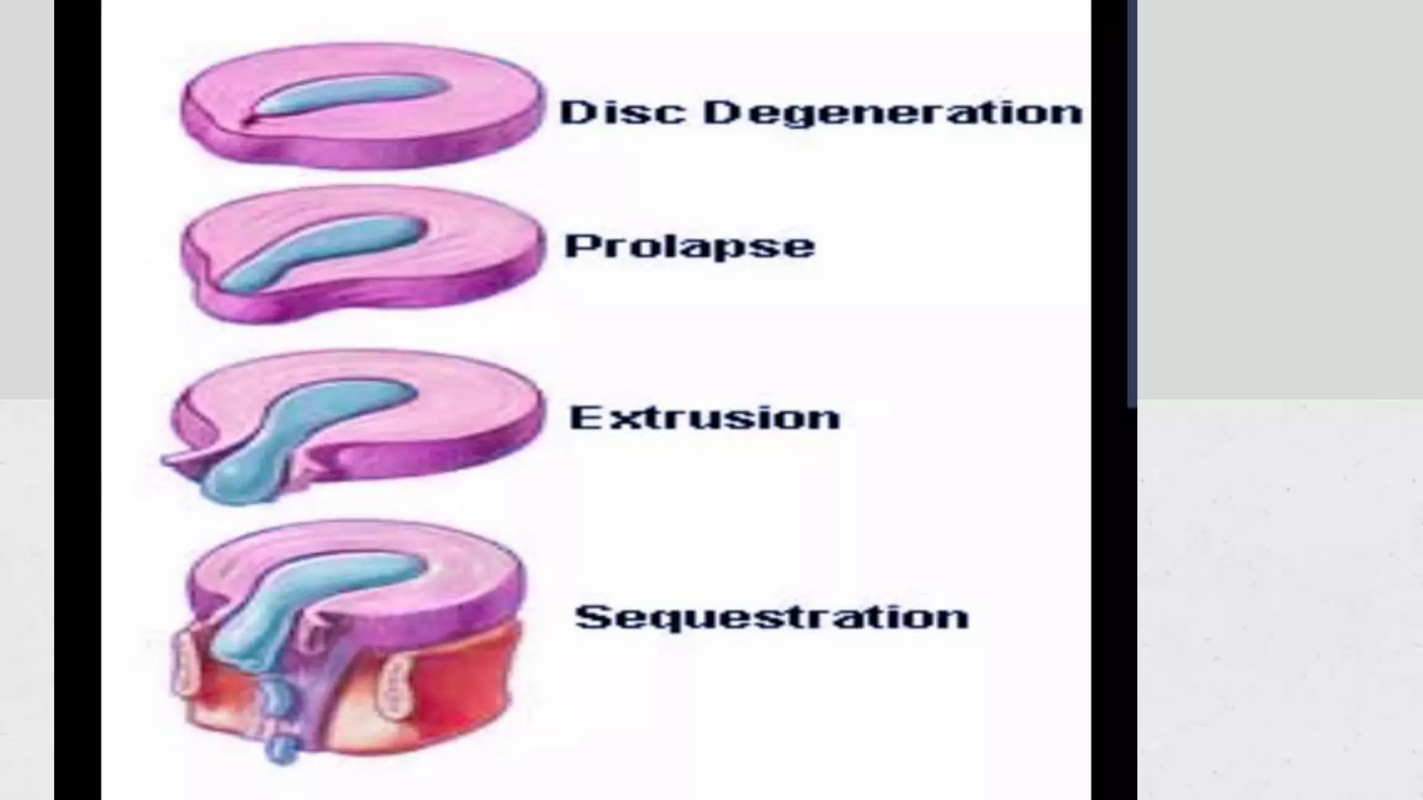 PIVD. ORTHO SLIDE SHARE | PPTX