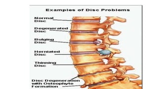 PIVD. ORTHO SLIDE SHARE | PPTX
