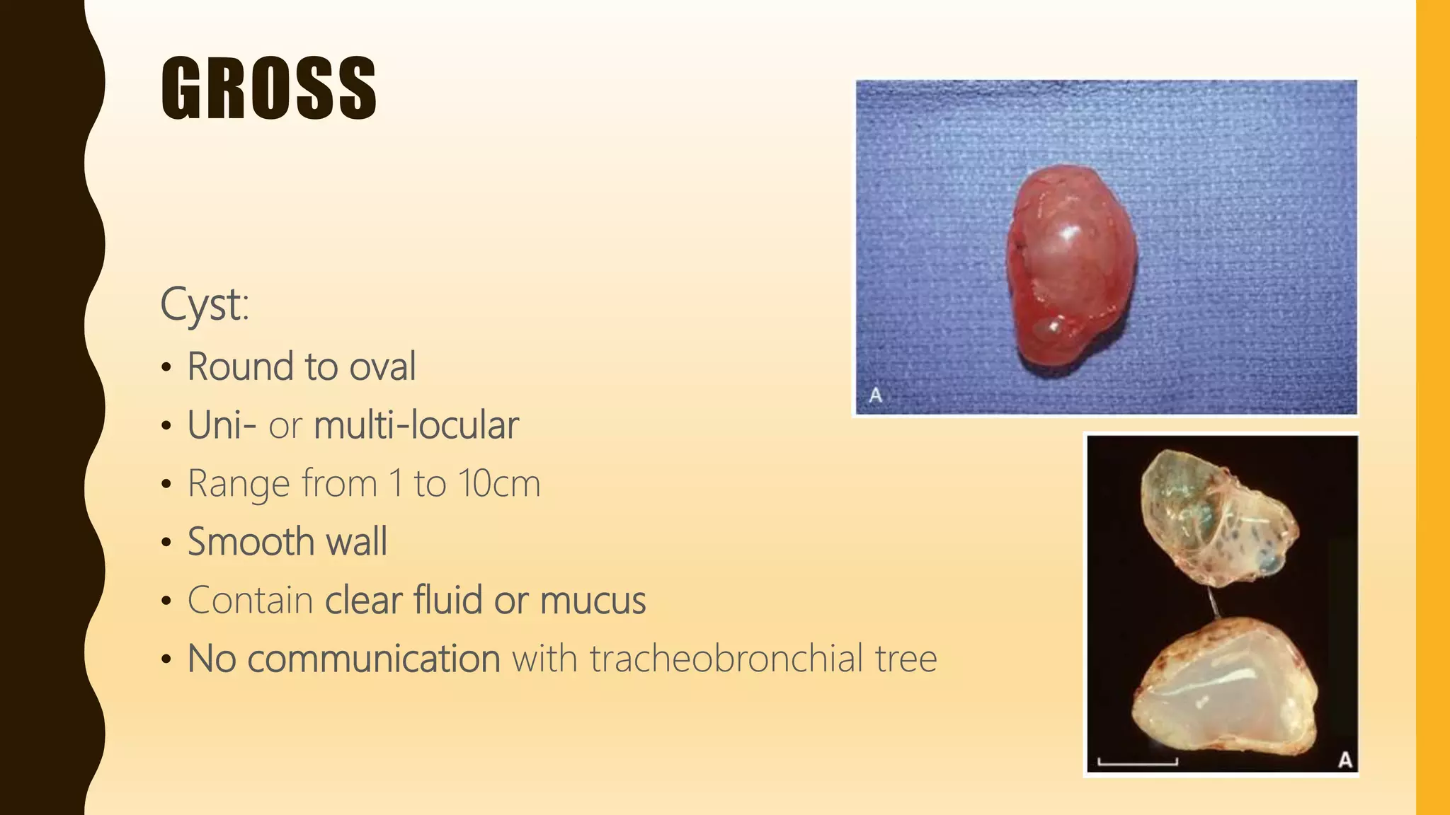 Flashpath - Lung - Bronchogenic cysts | PPTX