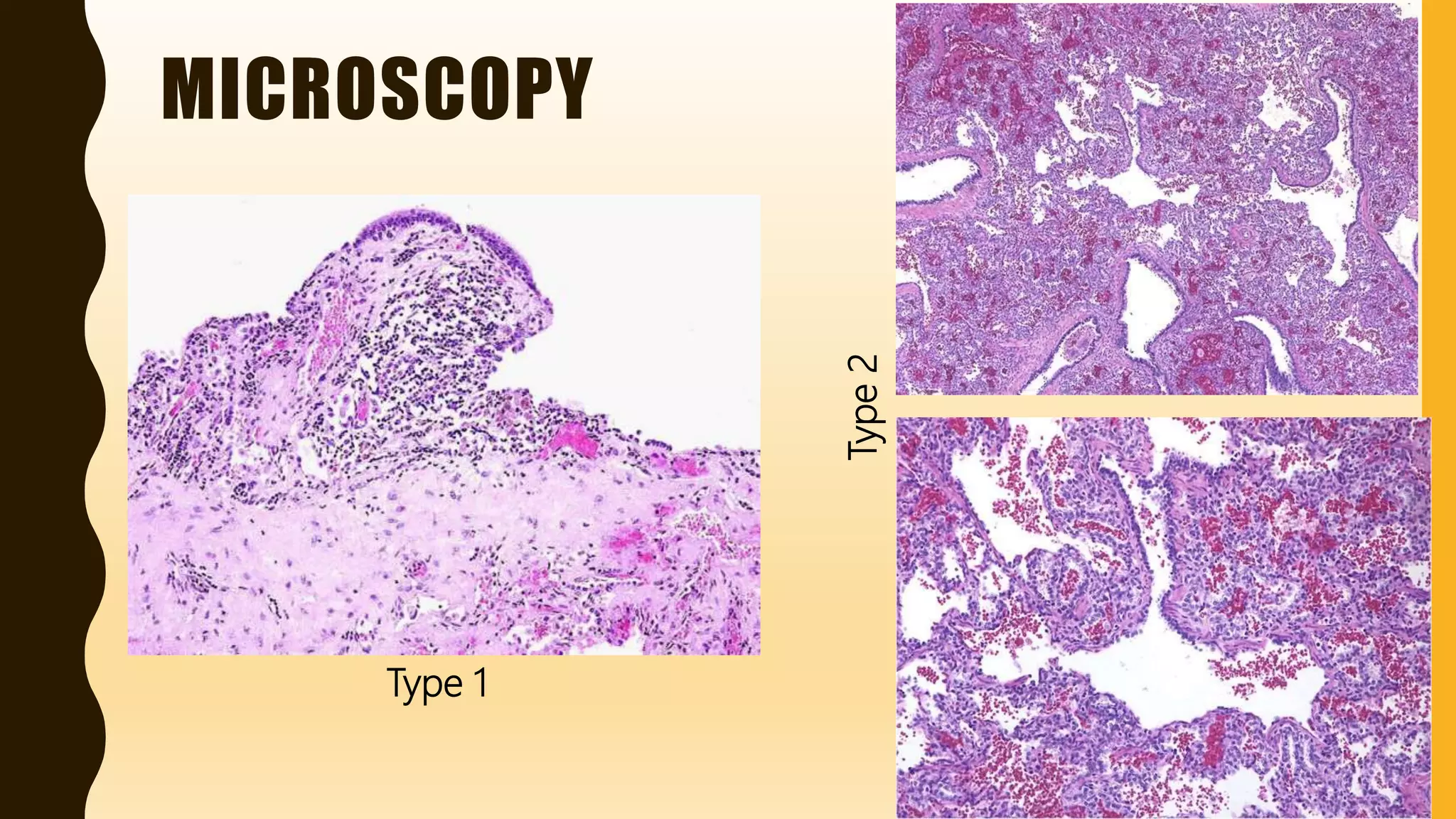 FlashPath - Lung - Congenital Pulmonary Airway Malformation | PPTX