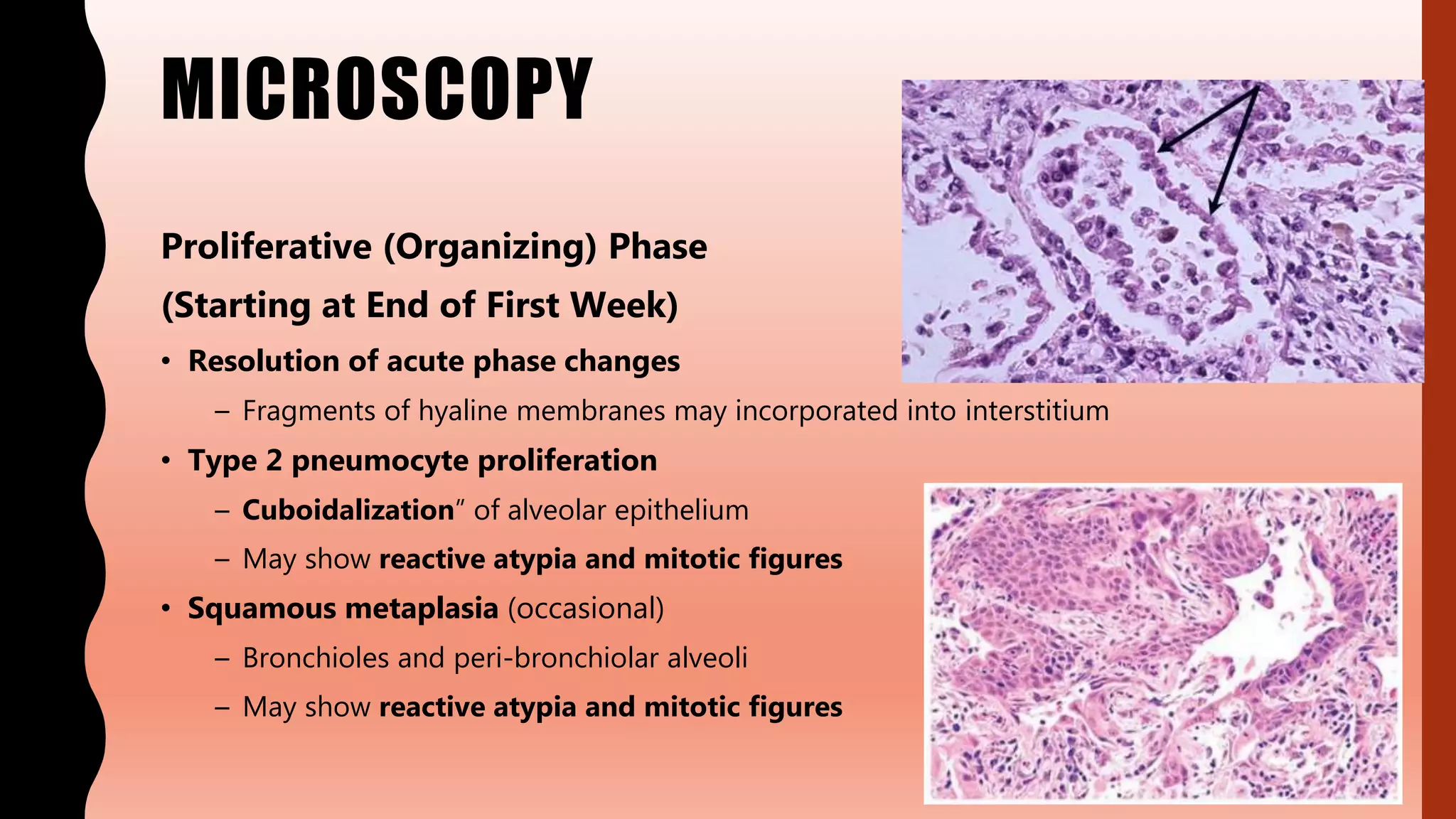 FlashPath- Lung - Diffuse Alveolar Damage / Acute Interstitial ...