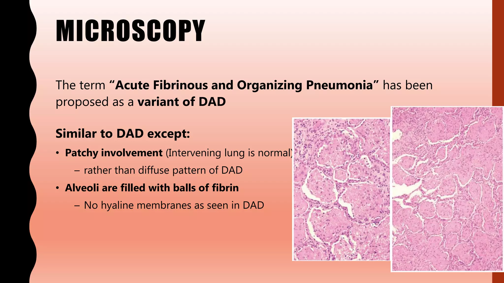 FlashPath- Lung - Diffuse Alveolar Damage / Acute Interstitial ...