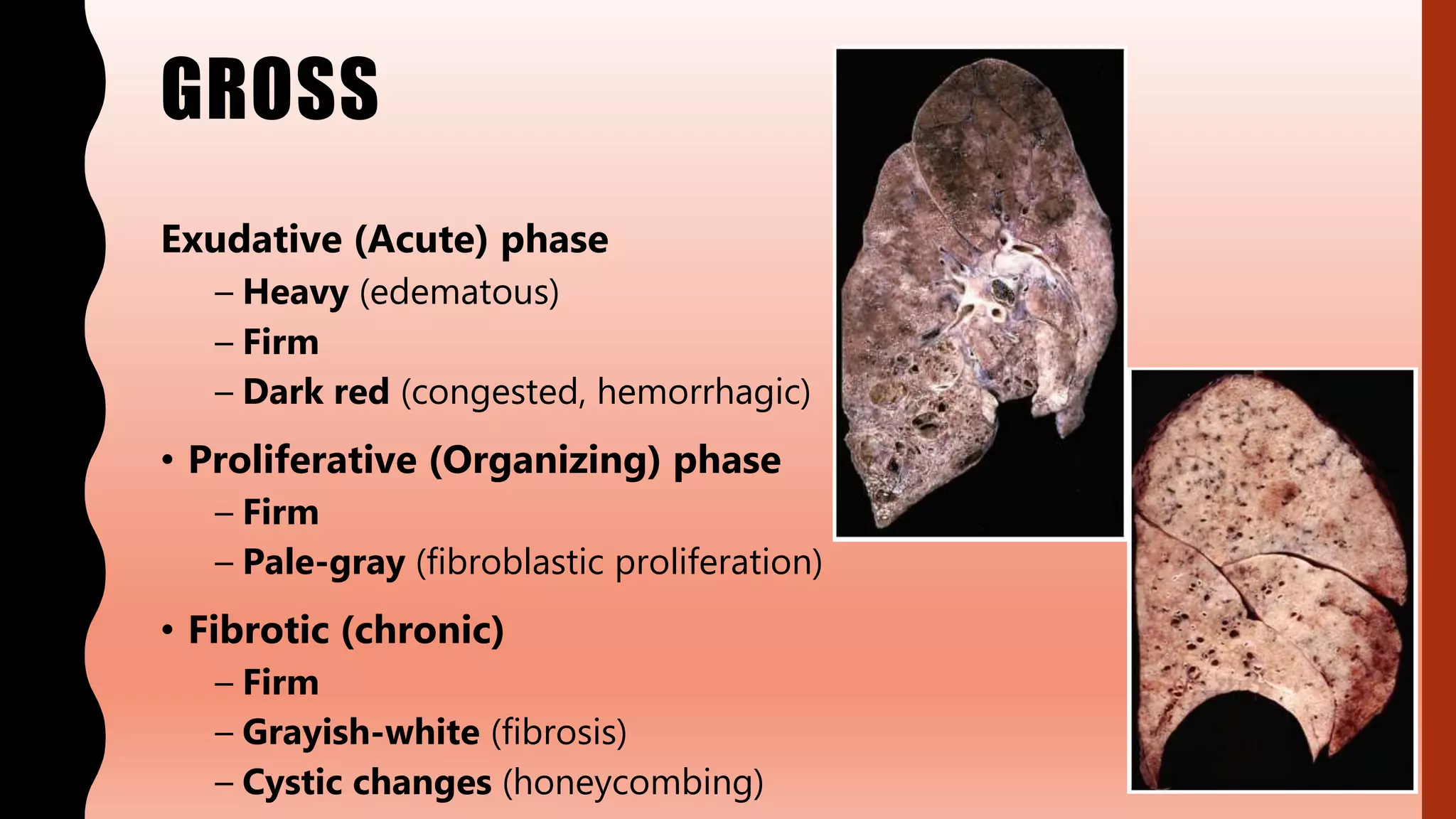 FlashPath- Lung - Diffuse Alveolar Damage / Acute Interstitial ...