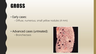 FlashPath - Lung - Diffuse Panbronchiolitis | PPT
