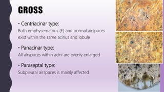 FlashPath - Lung - Emphysema | PPTX