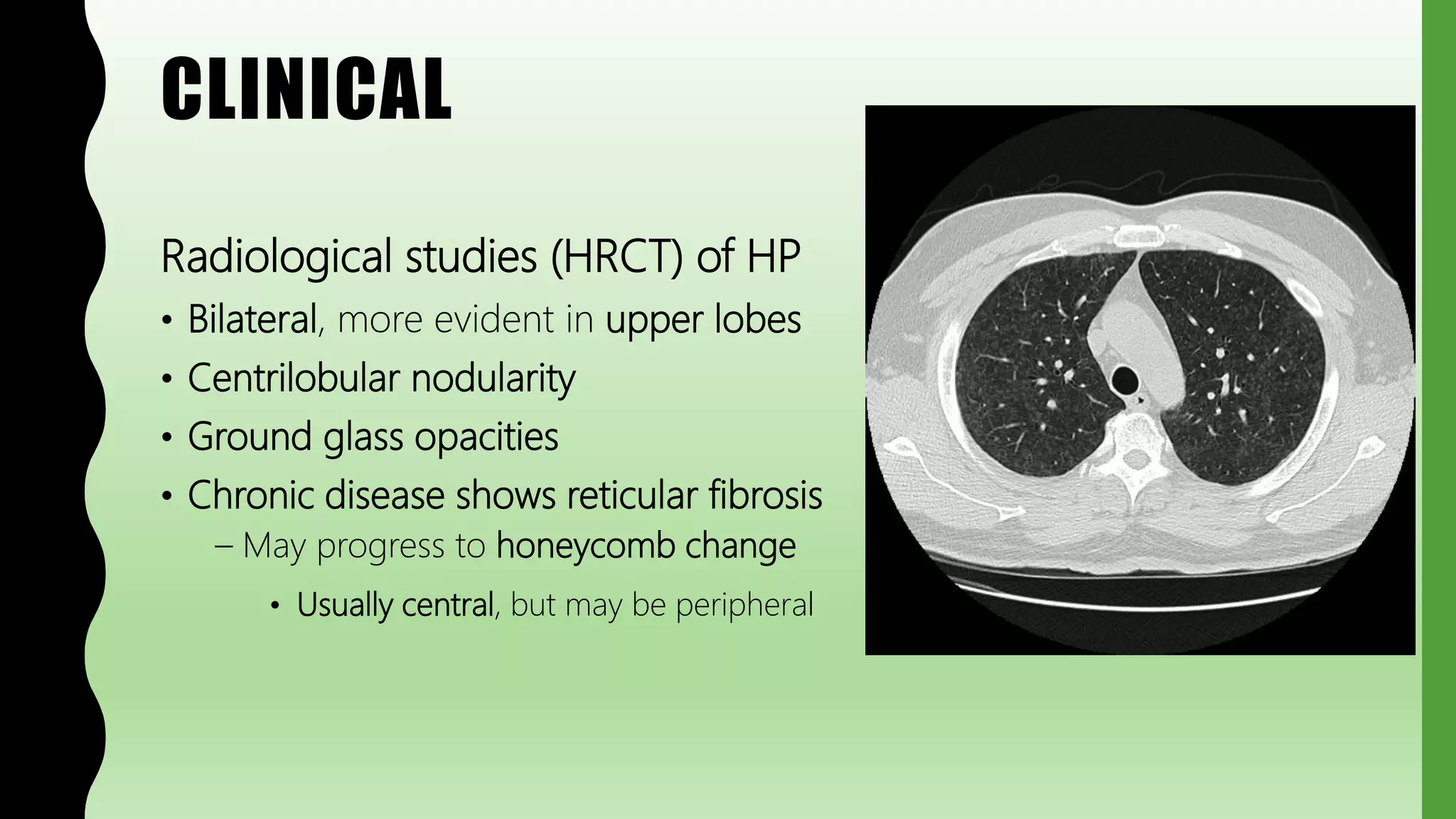 FlashPath - Lung - Hypersensitivity Pneumonitis - Extrinsic Allergic ...