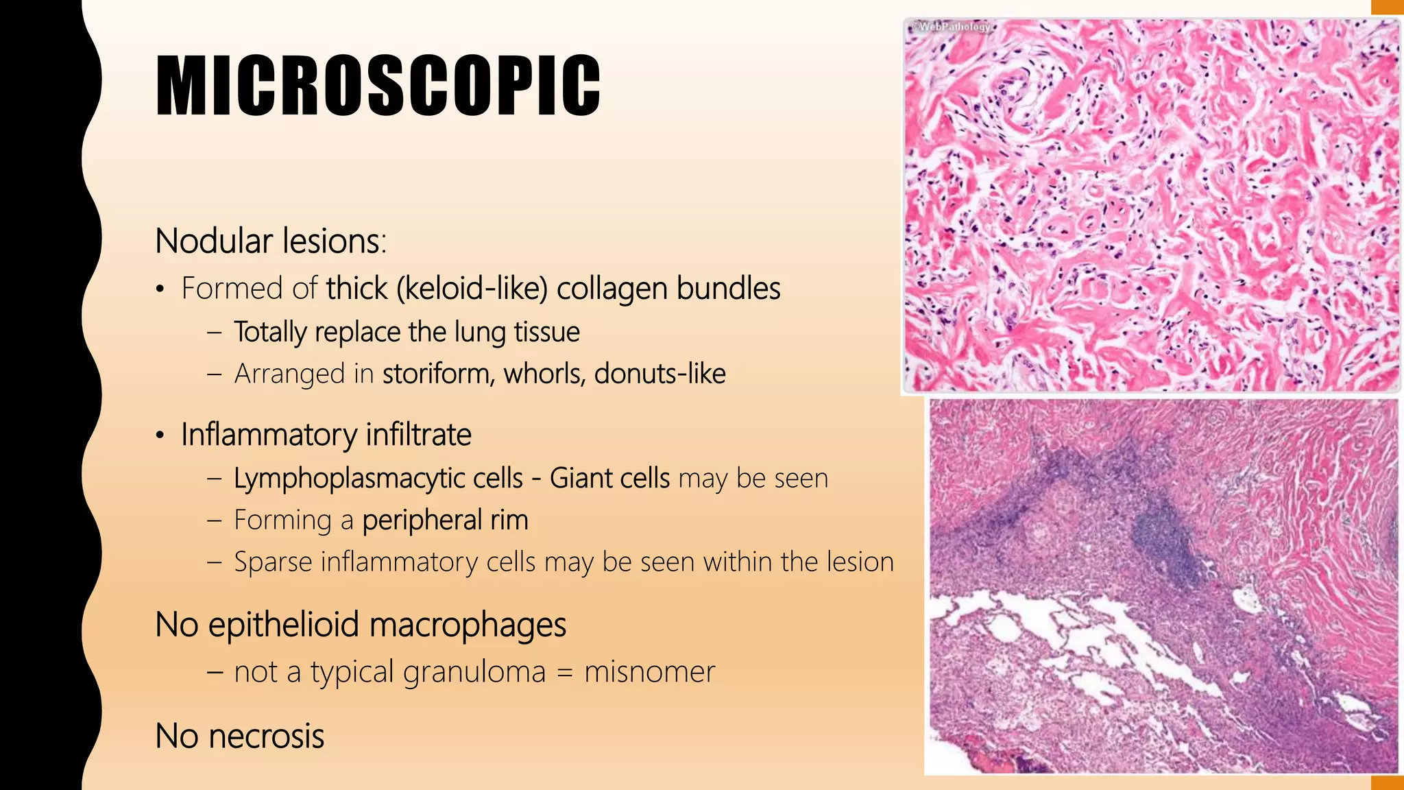 FlashPath- Lung - Pulmonary Hyalinizing Granuloma | PPTX