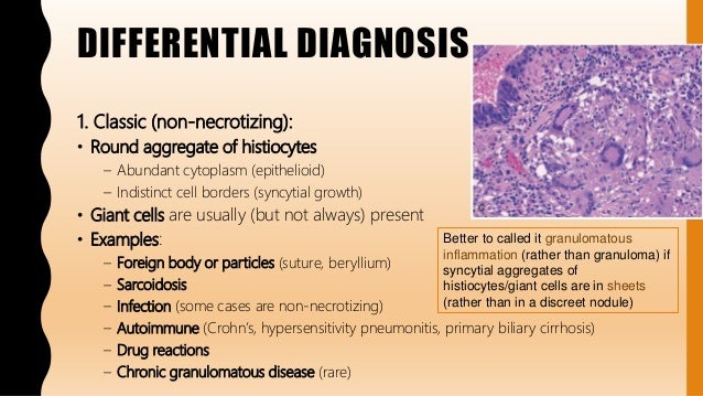 FlashPath- Lung - Pulmonary Hyalinizing Granuloma