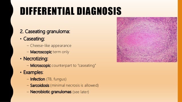 FlashPath- Lung - Pulmonary Hyalinizing Granuloma