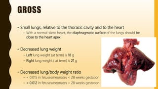 FlashPath - Lung - Pulmonary Hypoplasia | PPTX