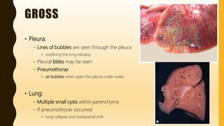 FlashPath - Lung - Pulmonary Interstitial Emphysema | PPTX