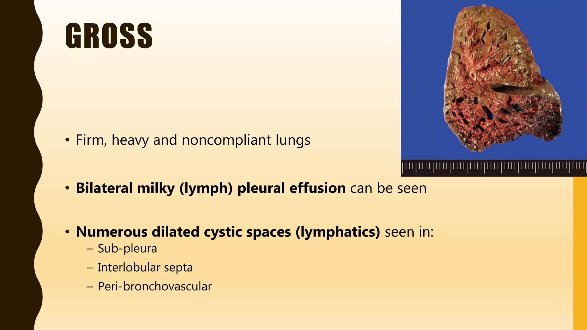 FlashPath - Lung - Pulmonary Lymphangiectasis | PPTX
