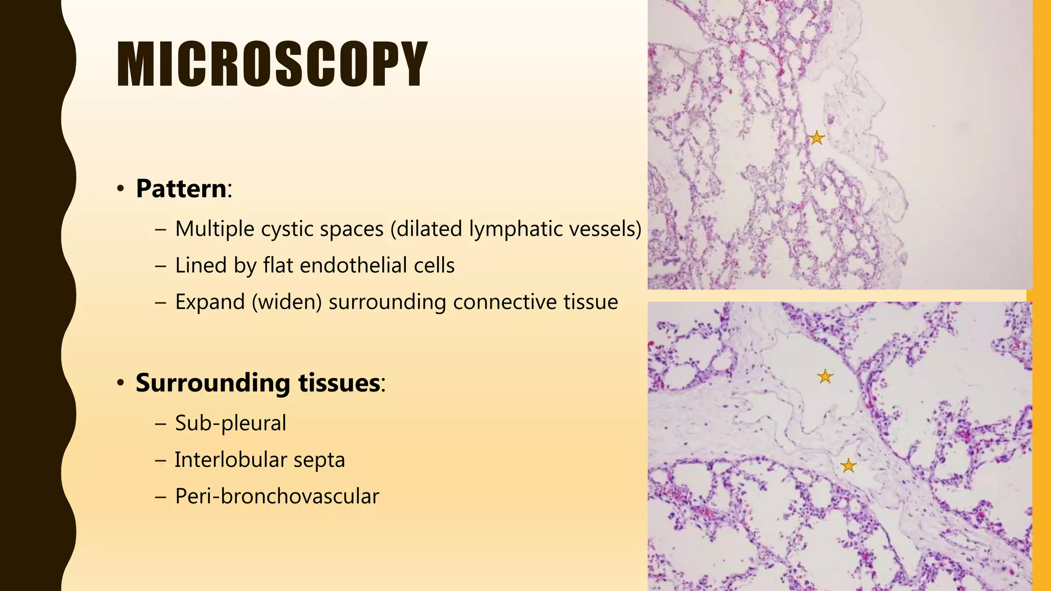 FlashPath - Lung - Pulmonary Lymphangiectasis | PPTX