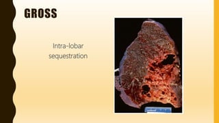 Flashpath - lung - pulmonary sequestration | PPTX