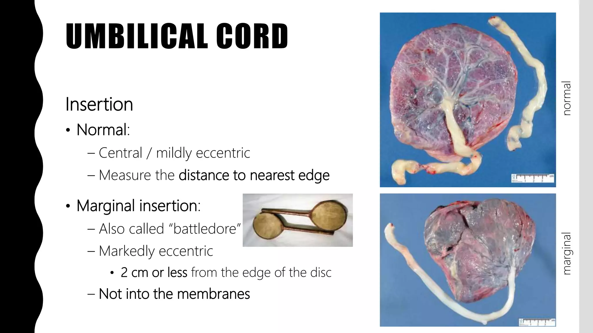 FlashPath - Placenta - Grossing | PPTX
