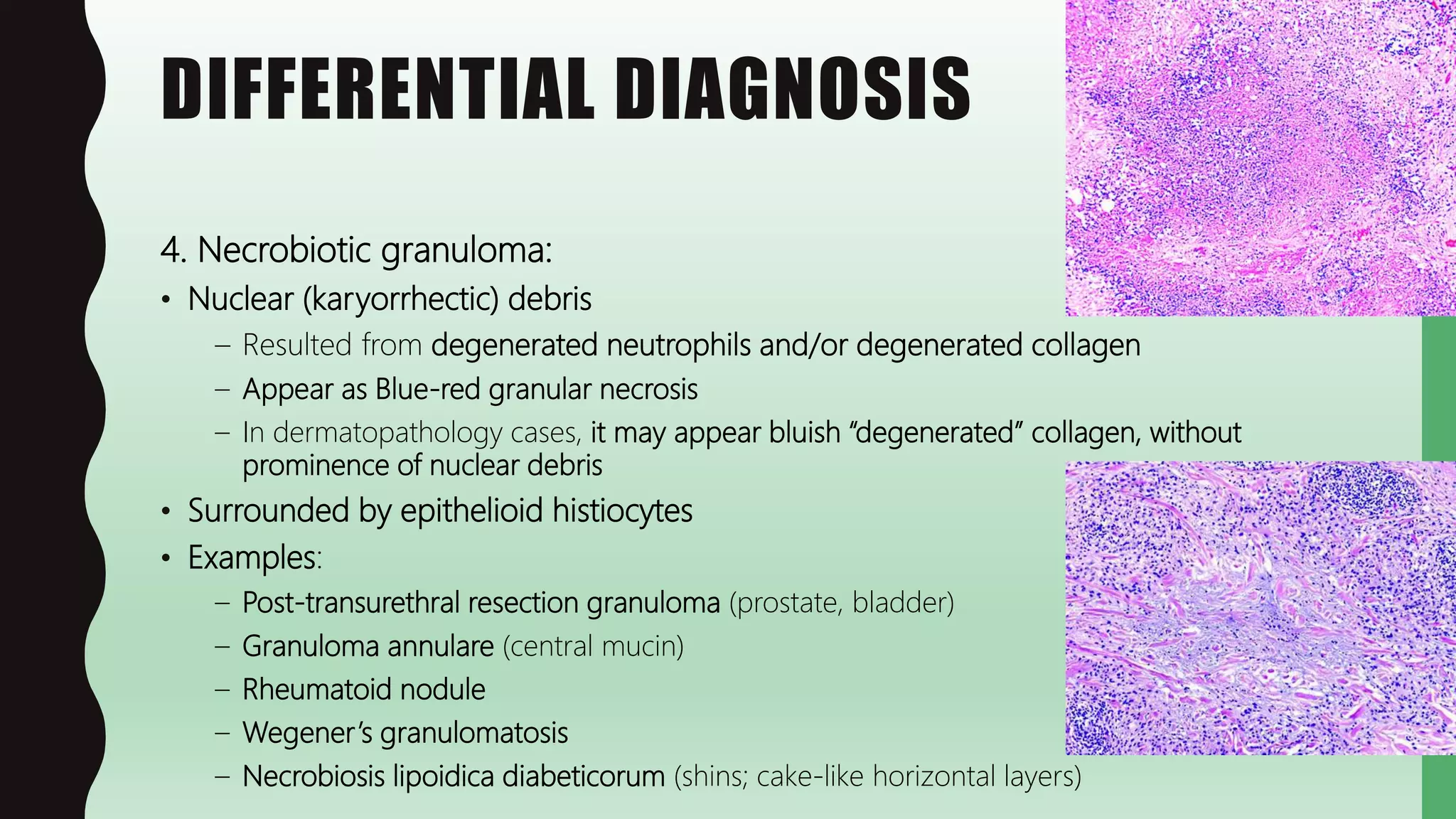 FlashPath - Sarcoidosis | PPTX