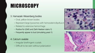 FlashPath - Sarcoidosis | PPTX