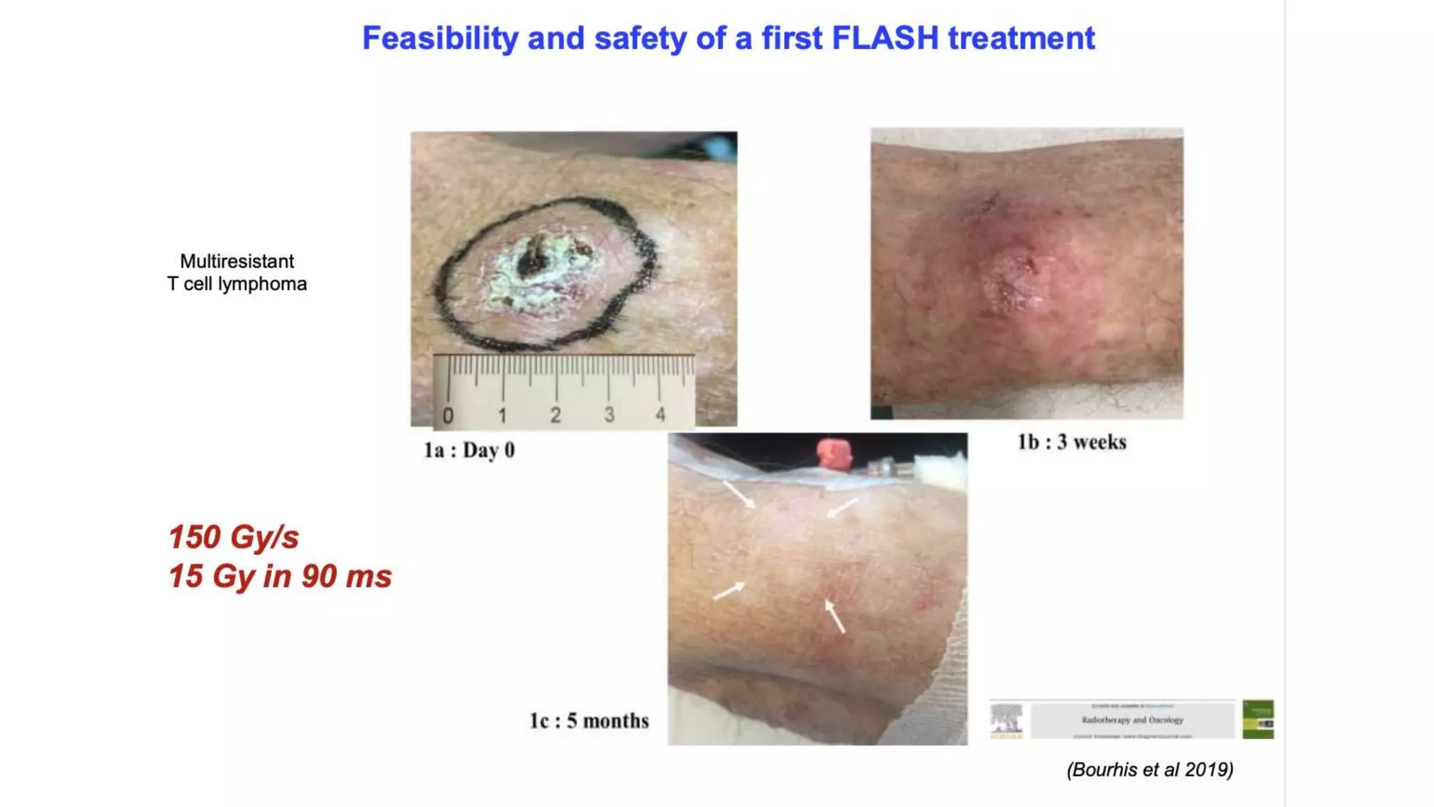 Flash radiation therapy | PPTX