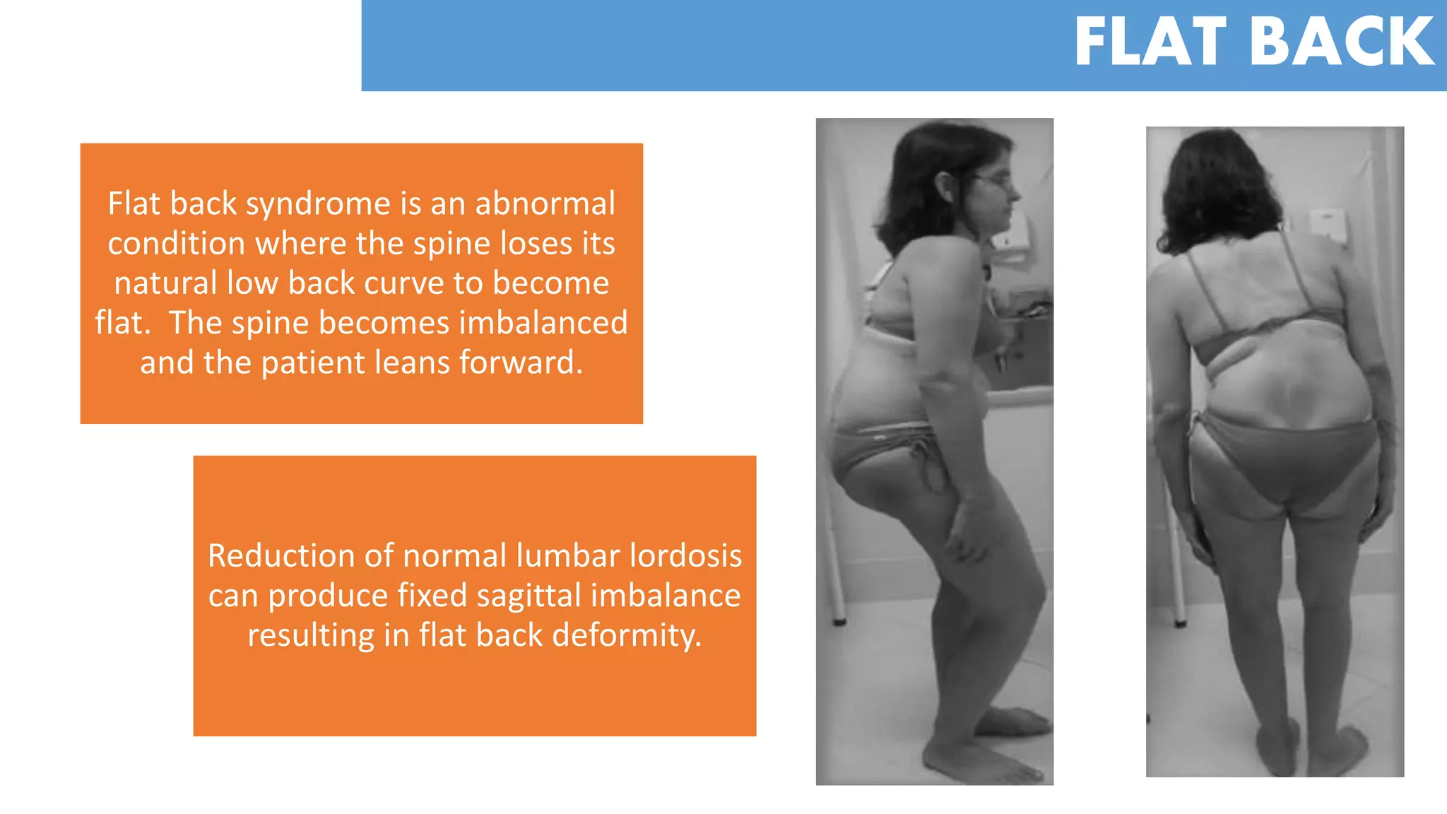 Flat back syndrome | PPTX