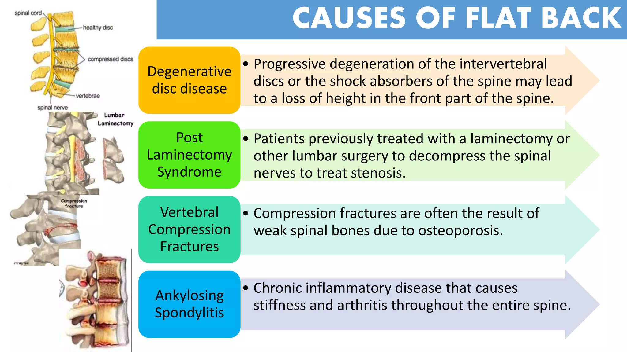 Flat back syndrome | PPTX