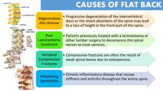 Flat back syndrome | PPTX