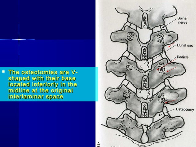 Flat back syndrome | PPT
