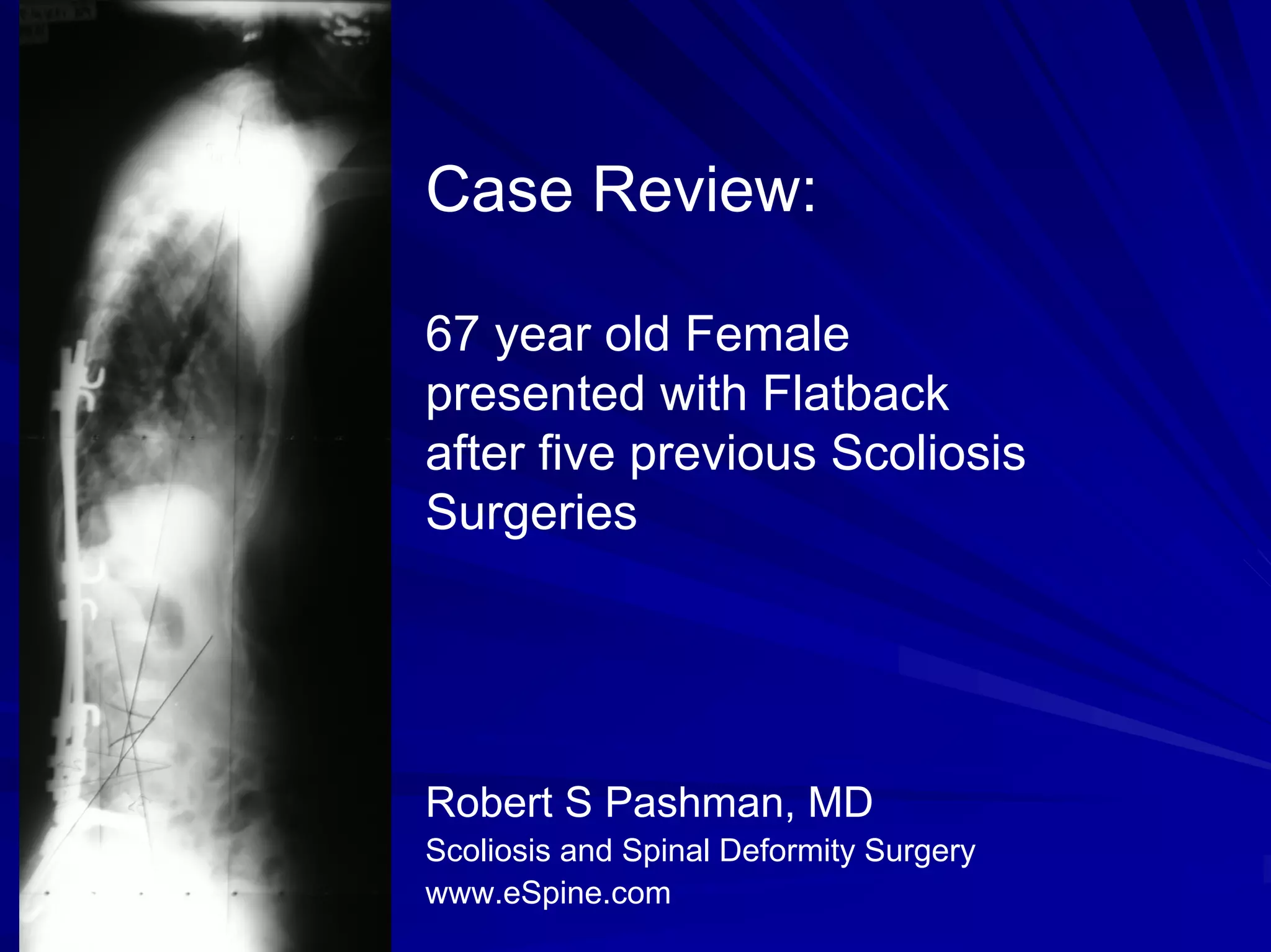 Case Review #5: 67 year old woman with flatback syndrome following 5 ...