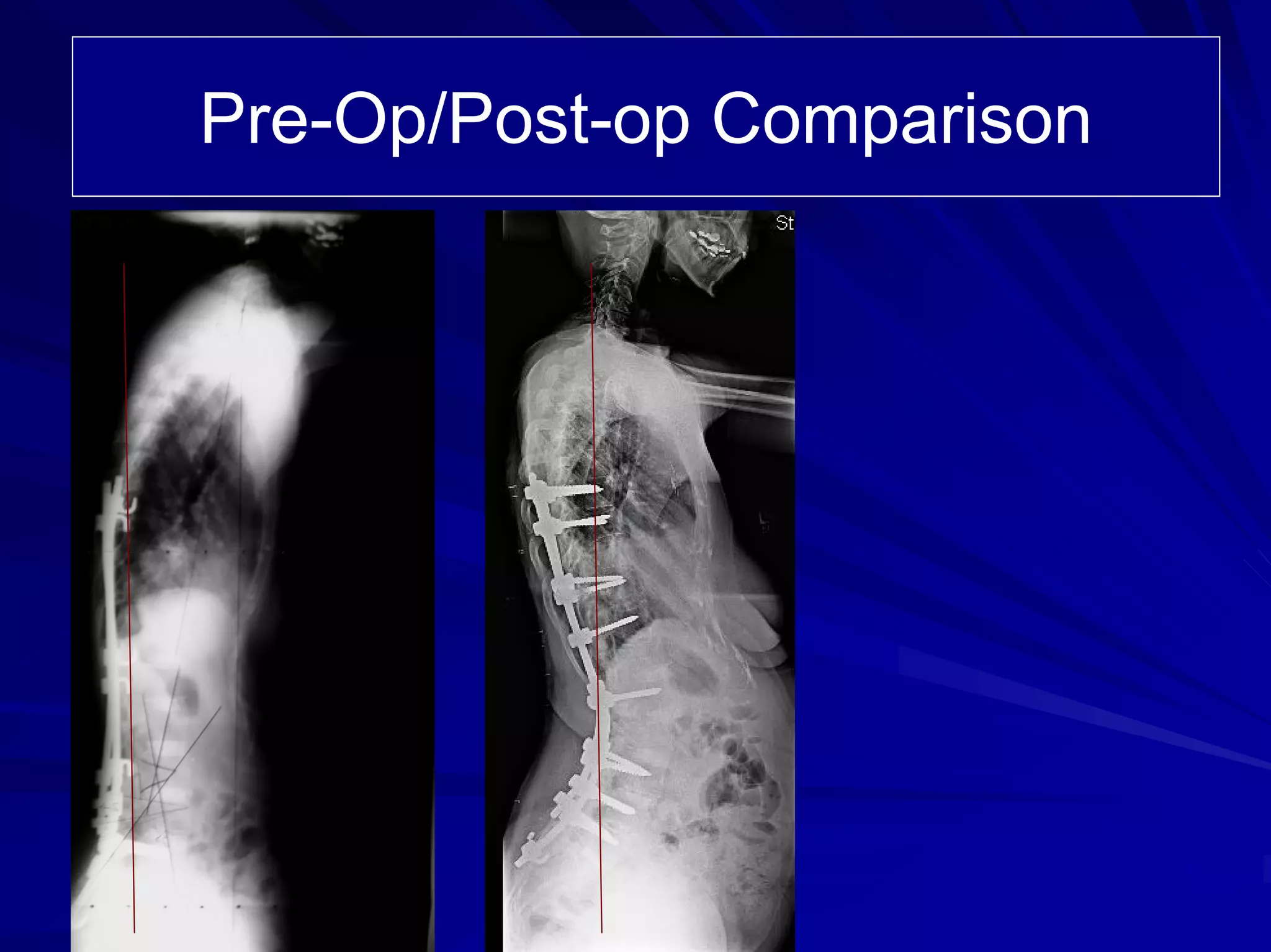 Case Review #5: 67 year old woman with flatback syndrome following 5 ...