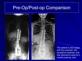 Case Review #5: 67 year old woman with flatback syndrome following 5 ...