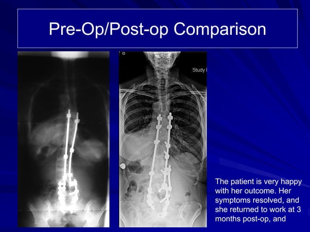 Case Review #5: 67 year old woman with flatback syndrome following 5 ...