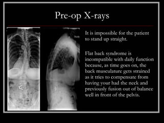 Case Review #6: 45 year old woman with flatback syndrome after several ...