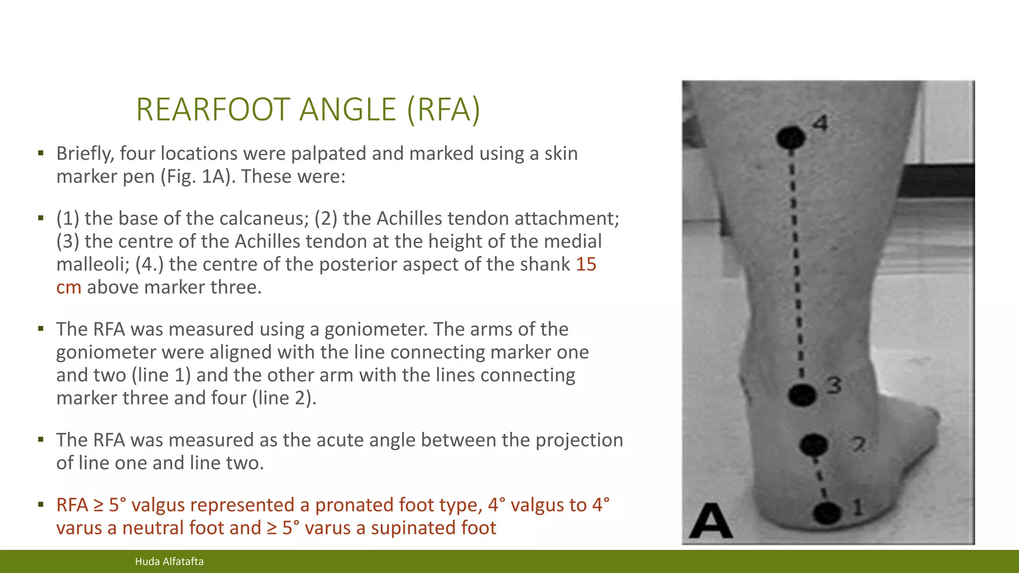 clinical examination of flat foot | PDF