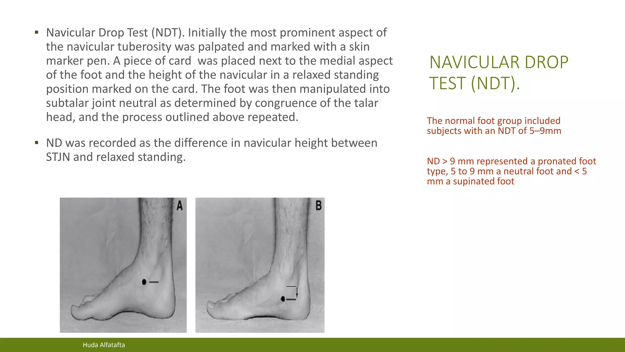 clinical examination of flat foot | PDF