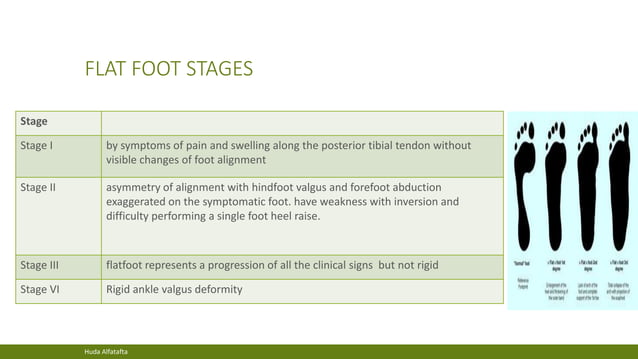 clinical examination of flat foot | PDF