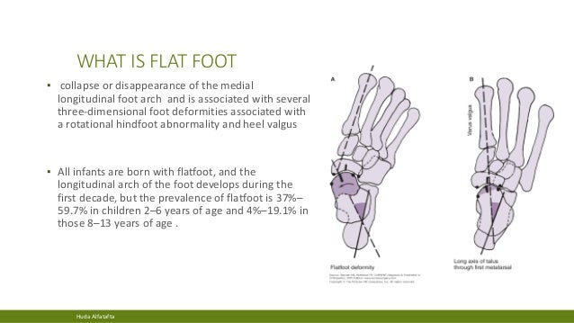 clinical examination of flat foot