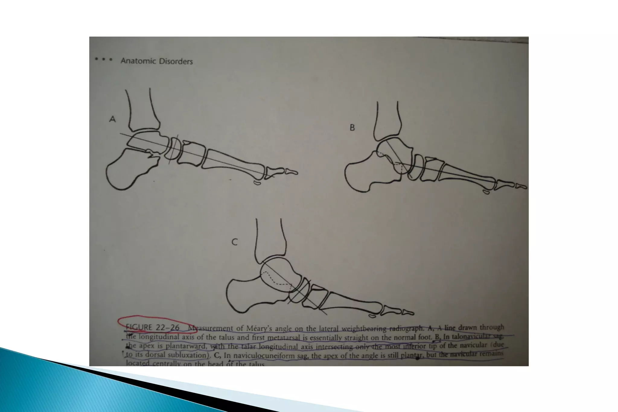 Flat foot | PPT | Death, Injury, or Military Conflict | Sensitive Topics
